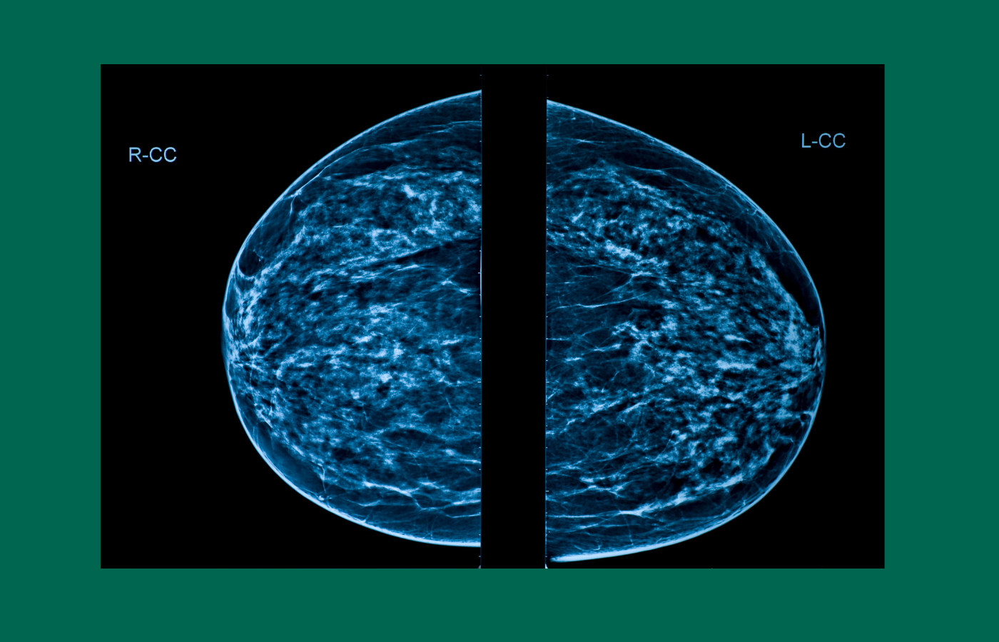 Dense Breast Tissue: What it means and why it matters | News & Stories ...